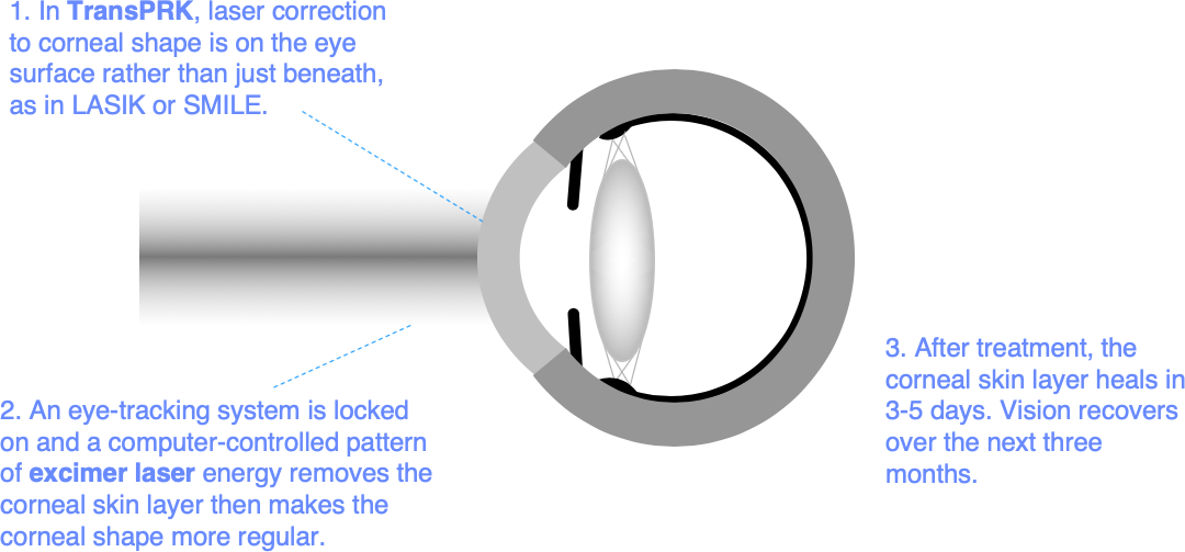 Transepithelial PRK and Corneal Crosslinking (TransPRK/CXL)